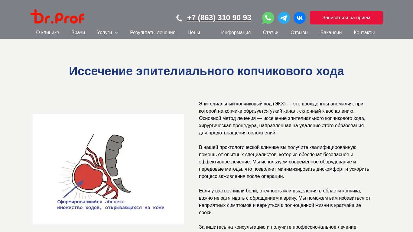 Иссечение эпителиального копчикового хода - клиника Doctor-Prof