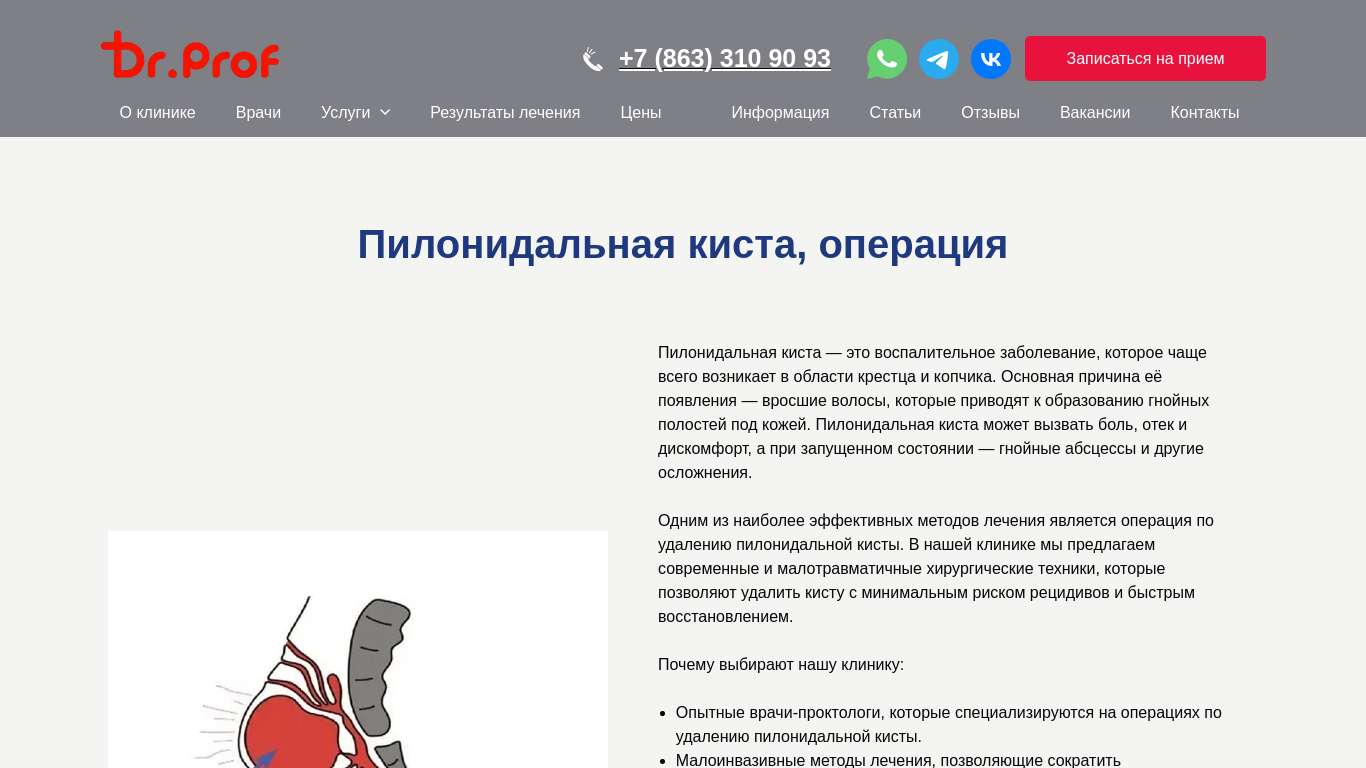 Пилонидальная киста, операция - клиника Doctor-Prof